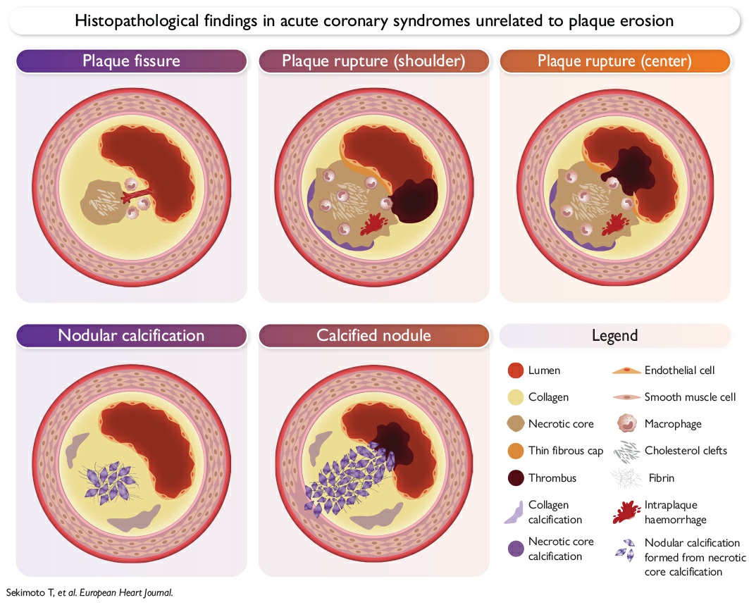 Plaque Fissure and Calcified Nodule: Histopathological Findings ...